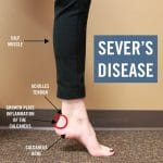 Common Heel Injury in Children: What is Sever’s Disease? - Coury ...